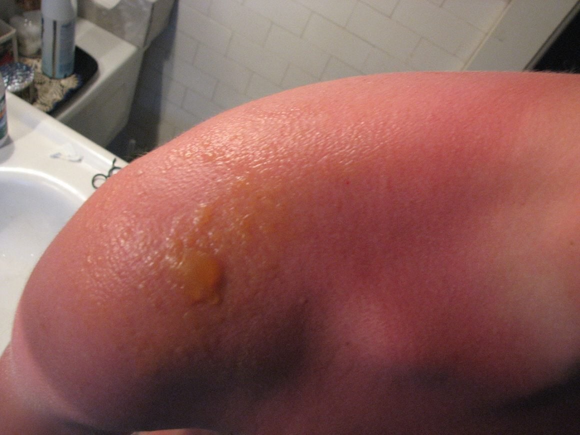 sunburn blisters of a person exposed to a significant amount of sun for ...