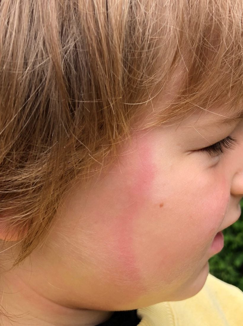 lyme disease rash. photo by Guswen Wikimedia Commons - Earth Buddies